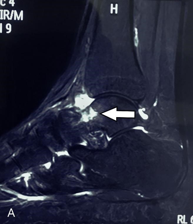 Tratamiento Artroscópico del Osteoma Osteoide en el Astrágalo - Revista ...