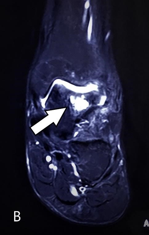 Tratamiento Artroscópico del Osteoma Osteoide en el Astrágalo - Revista ...