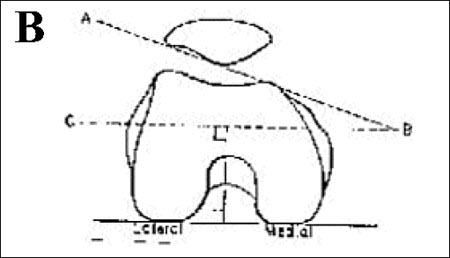 Sindrome de compresión lateral de la rótula y liberación del retináculo ...