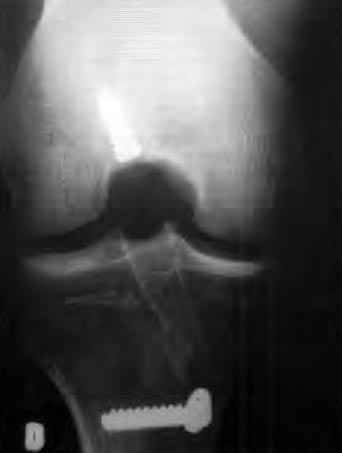 Ensanchamiento del túnel tibial tras reconstruir LCA con injerto de ...