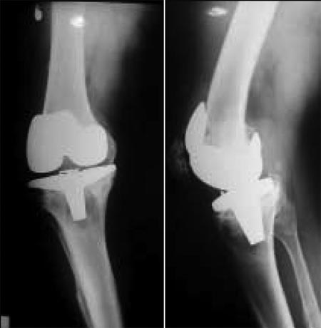 Injerto óseo en la cirugía de revisión del reemplazo total de rodilla ...