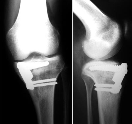 Fractura de Espina Tibial con Fisis Abierta. Deformidad Tibial ...