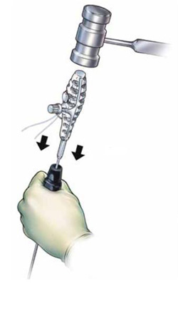 Reparación Artroscópica del Labrum Glenoideo con Anclajes Blandos ...