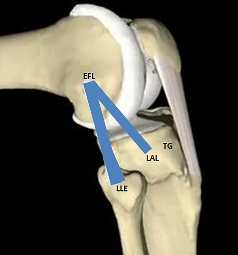 Ligamento Anterolateral de Rodilla. Reconstrucción Anatómica con ...